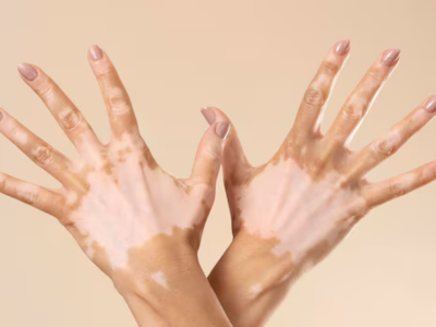 Skin Conditions in Lucknow - Causes & Effective Treatments